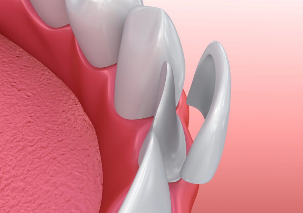 Porcelain Veneers Procedure Maple Grove MN - Cosmetic Dentist